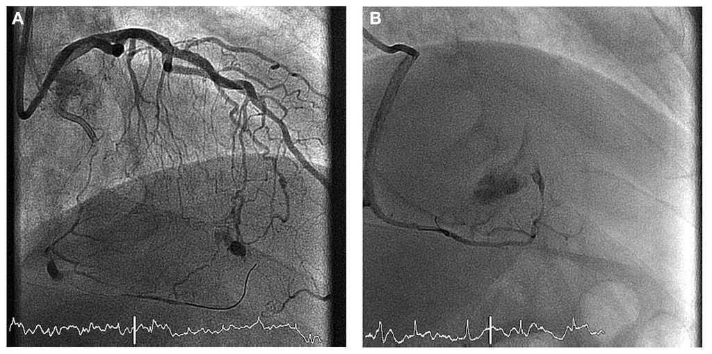 Left Coronary Artery Angiogram