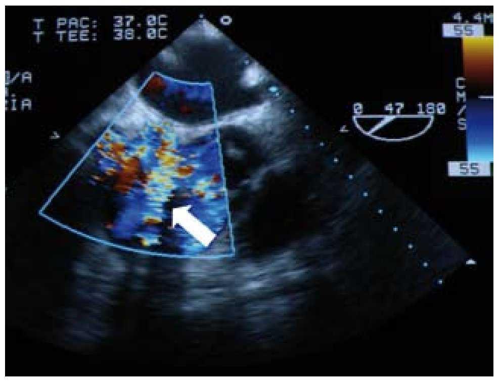 Coronary Mycotic Aneurysm and Septic Pulmonary Embolism | Revista ...