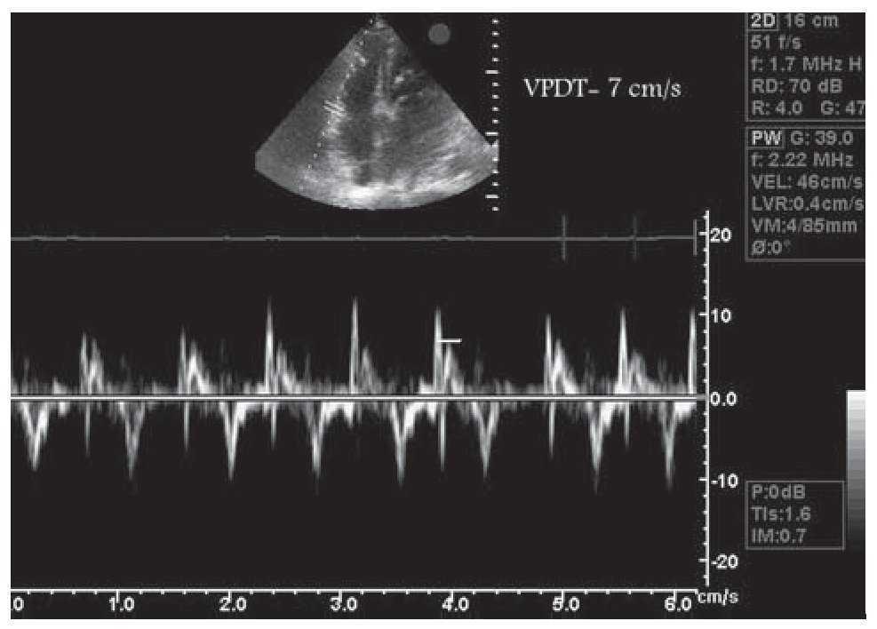 Variabilidad inter e intraobservador en la valoración ecocardiográfica ...