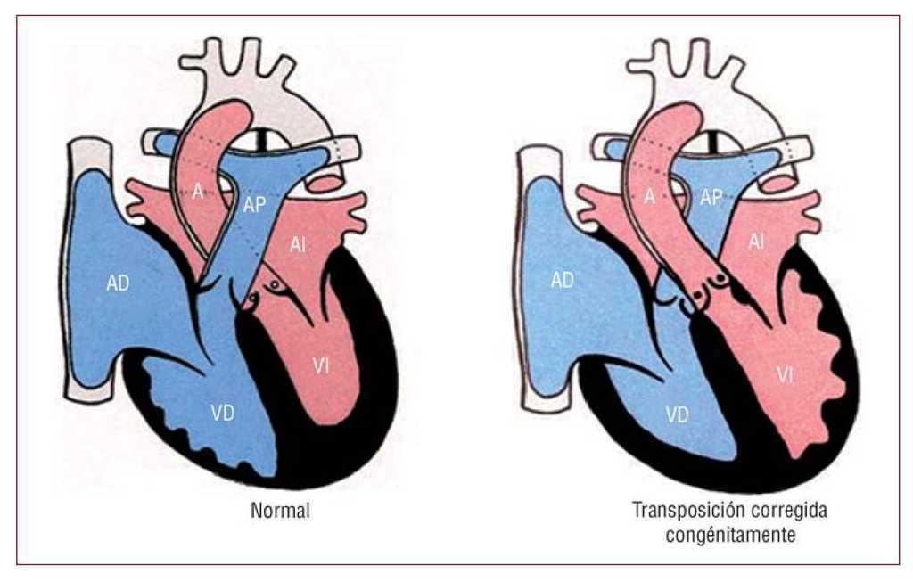 Ventrículo Derecho Y Cardiopatías Congénitas En El Adulto Revista