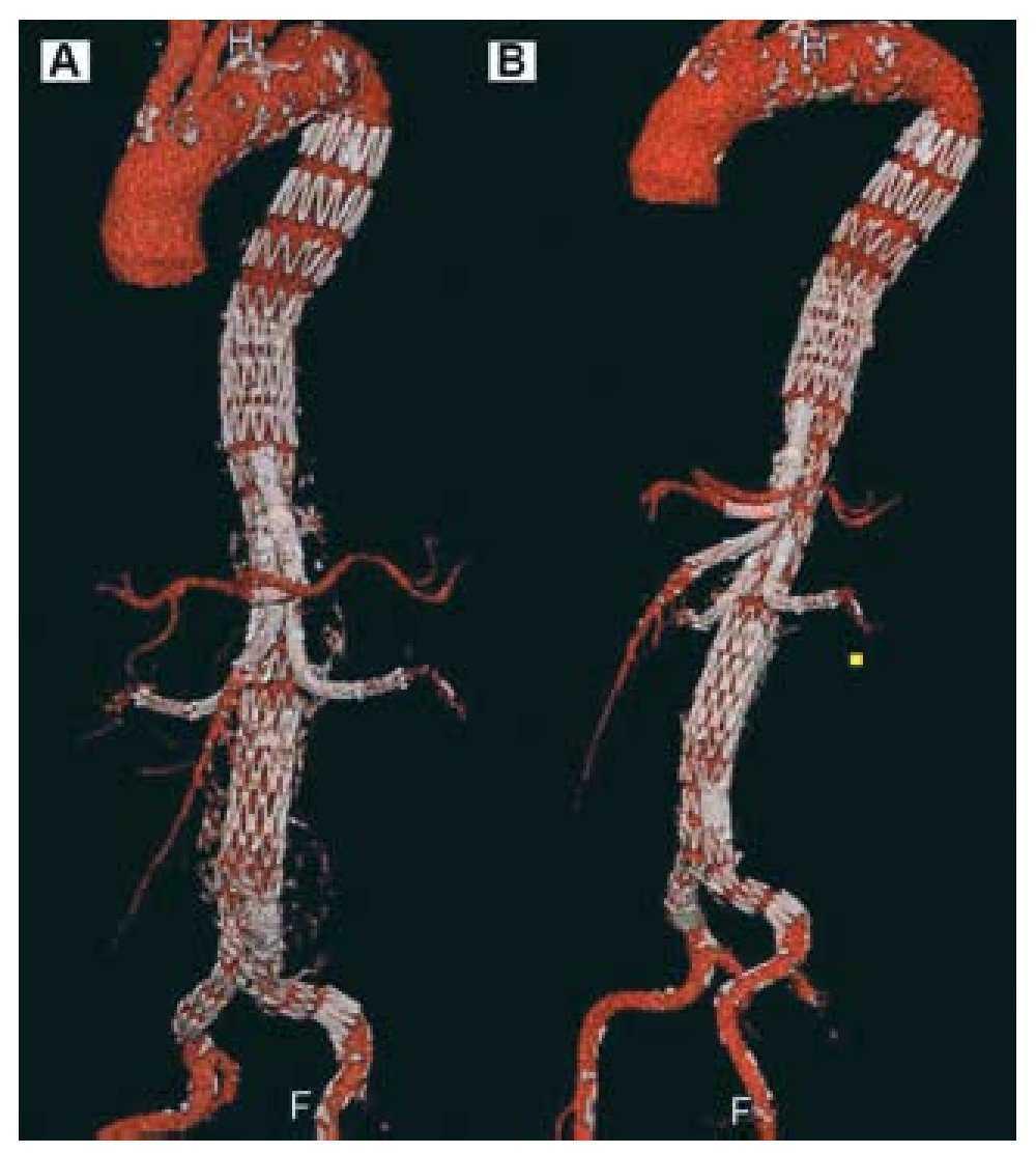 Branched Stent-Graft Used for the Complete Endovascular Treatment of a ...
