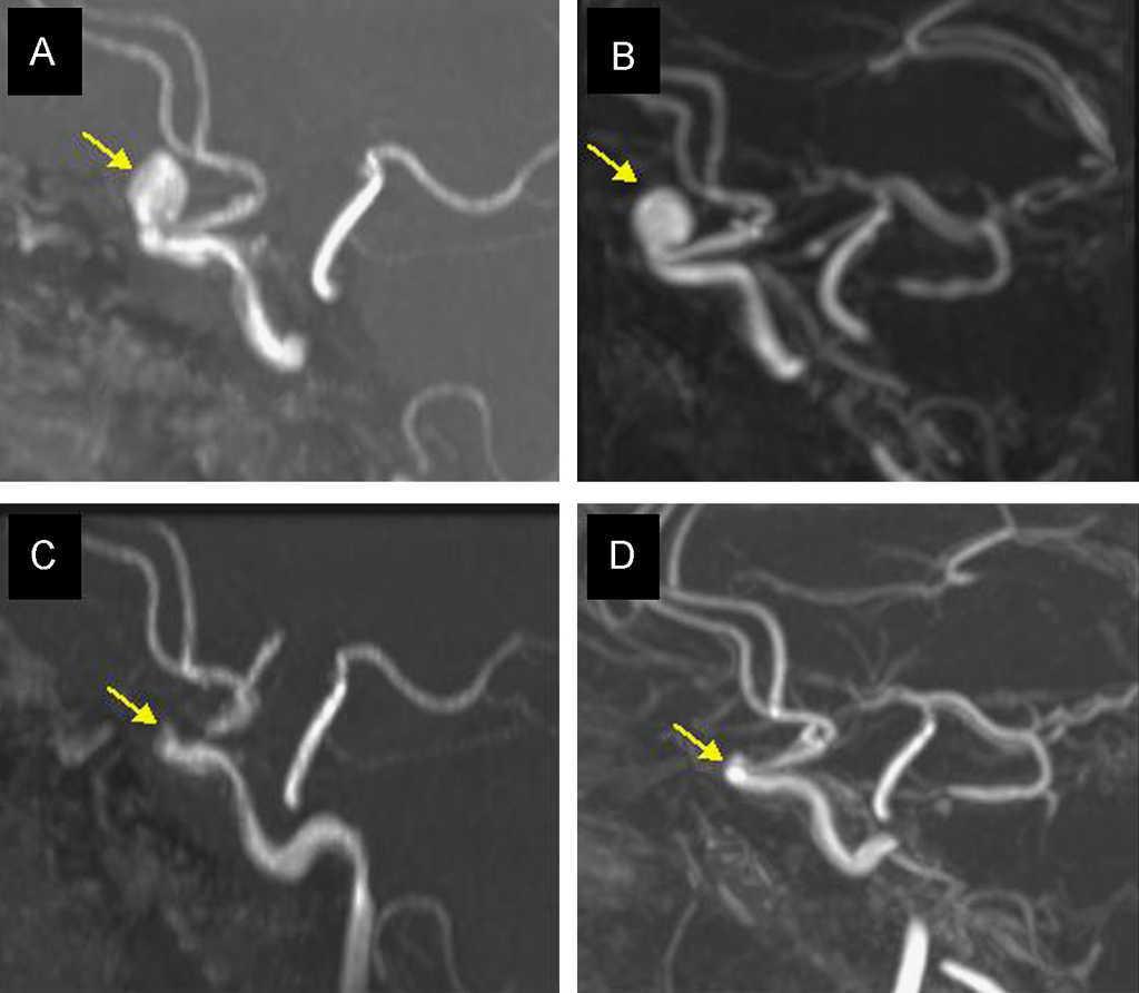 Seguimiento mediante angio-resonancia magnética de aneurismas ...