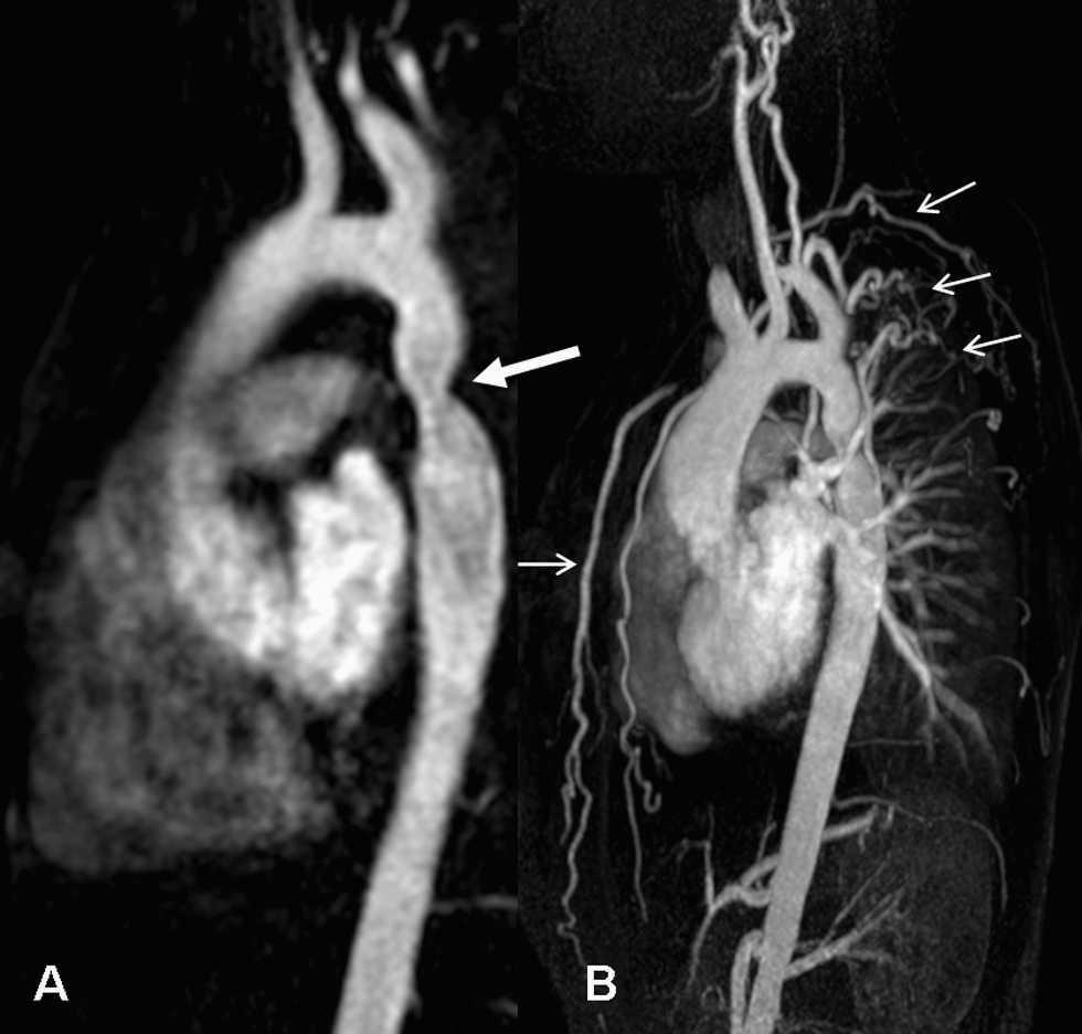 Angiografía con contraste por resonancia magnética en las cardiopatías ...