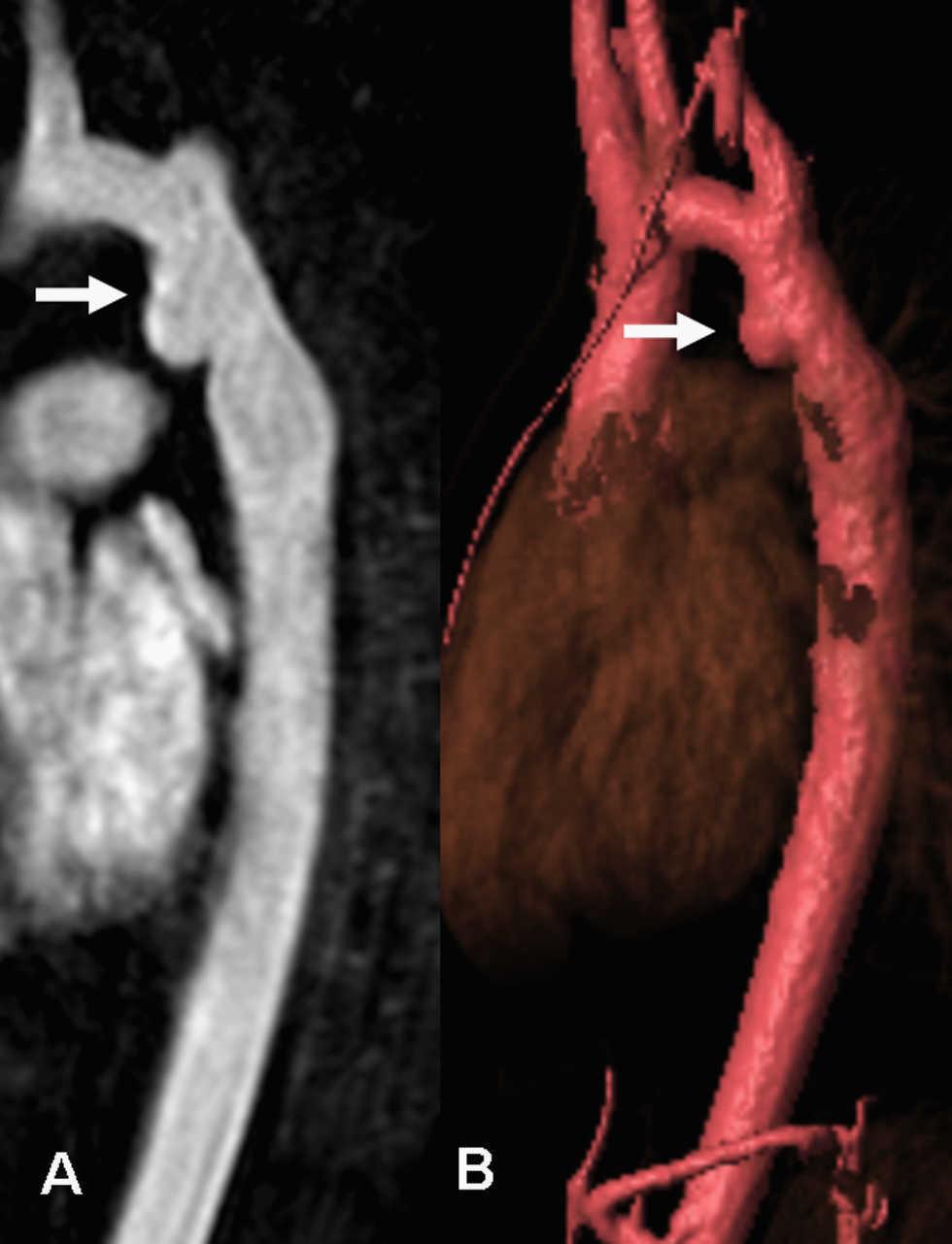 Angiografía con contraste por resonancia magnética en las cardiopatías ...