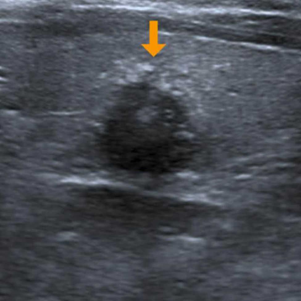 Nódulo Hipoecogênico No útero - RETOEDU