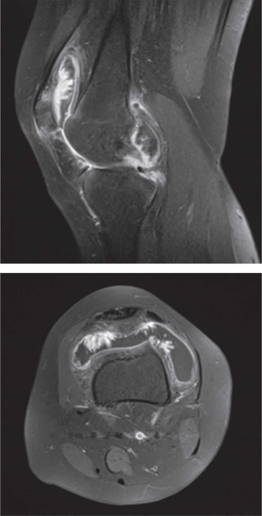 Sinovitis villonodular pigmentada focal como diagnóstico diferencial de ...