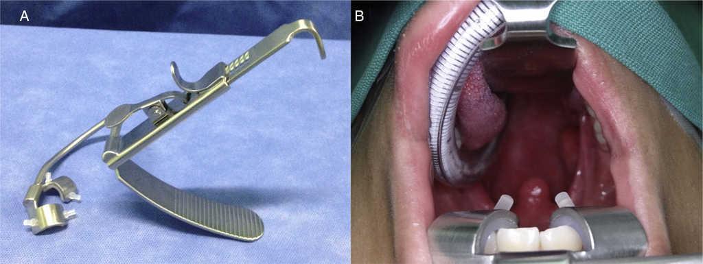 Cirugía Robótica Transoral (TORS), en el manejo de lesiones neoplásicas ...