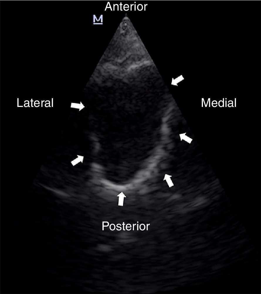 Maxillary sinusitis diagnosed by ultrasound | Medicina Intensiva