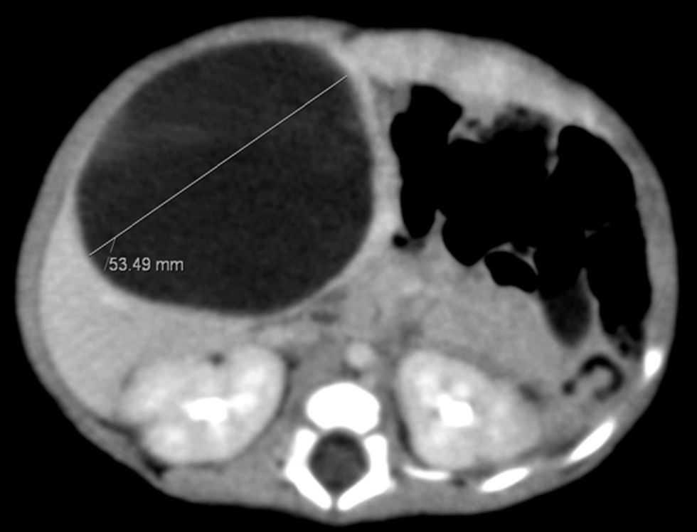 Quiste hepático simple congénito: un desafío diagnóstico y terapéutico ...