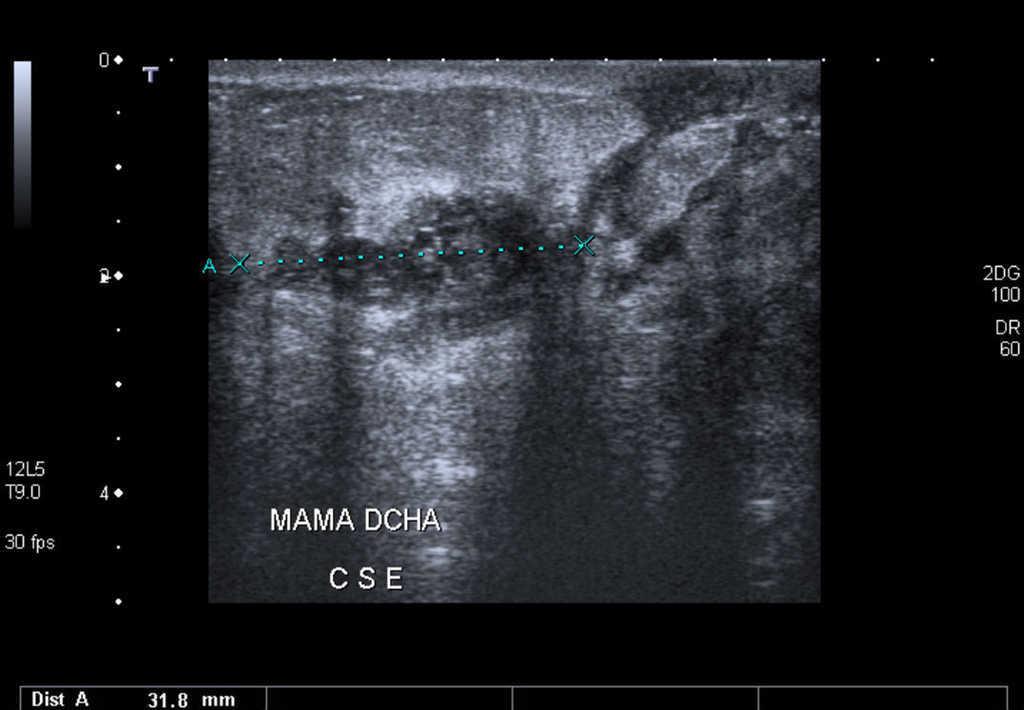 Mastitis granulomatosa | Clínica e Investigación en Ginecología y ...