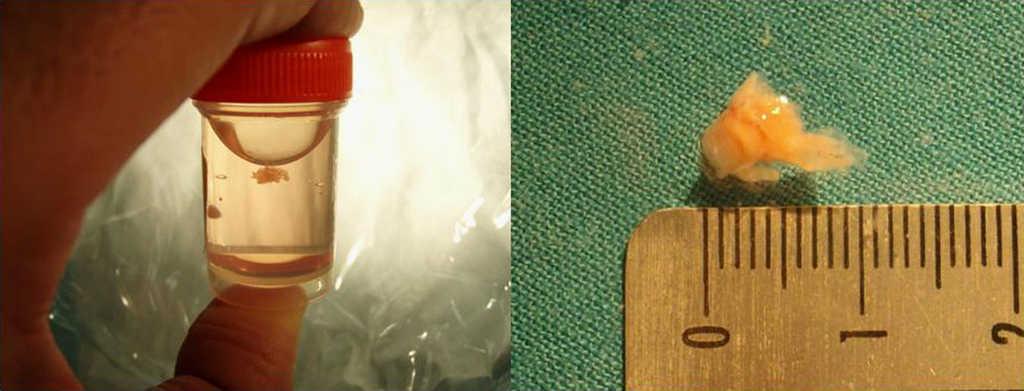 Utilización de criosondas para la realización de la biopsia pulmonar ...