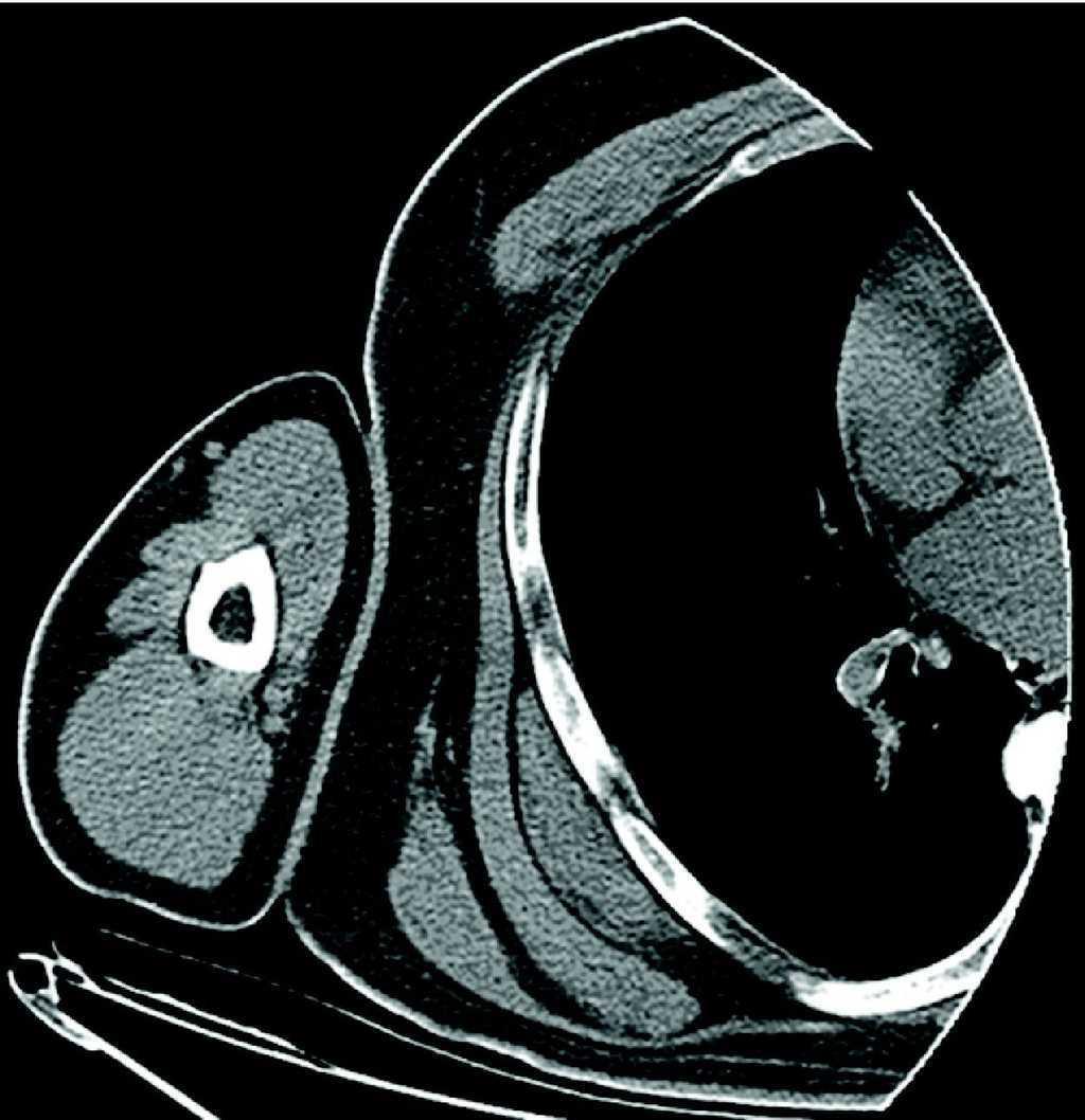 Fibroelastoma dorsi: un tumor infrecuente e infradiagnosticado ...