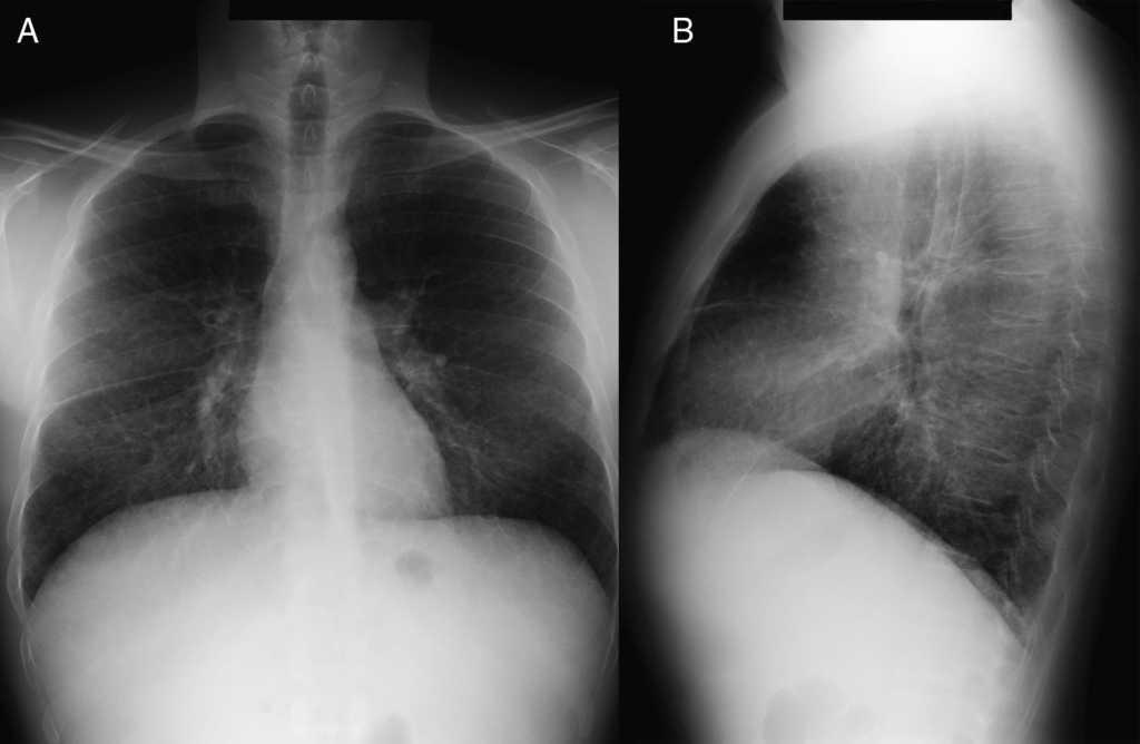 Afectación pulmonar en paciente adulto con enfermedad de Niemann-Pick ...