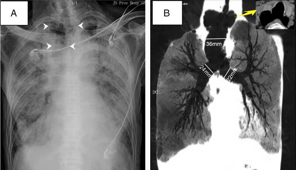 Tracheobronchomegaly in Intubated Ventilation of ARDS | Archivos de ...