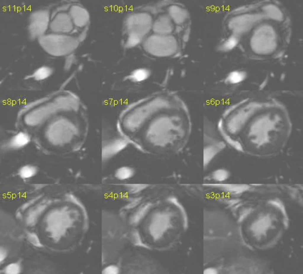 Resonancia magnética cardiaca en miocardiopatía arritmogénica. Tipos de ...