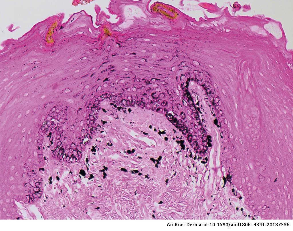 Lingual Melanotic Macule The First Case Report In An Adult Patient Anais Brasileiros De