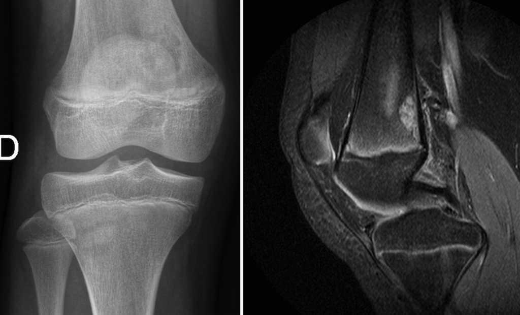 Lesiones y variantes normales de la rodilla pediátrica | Revista ...