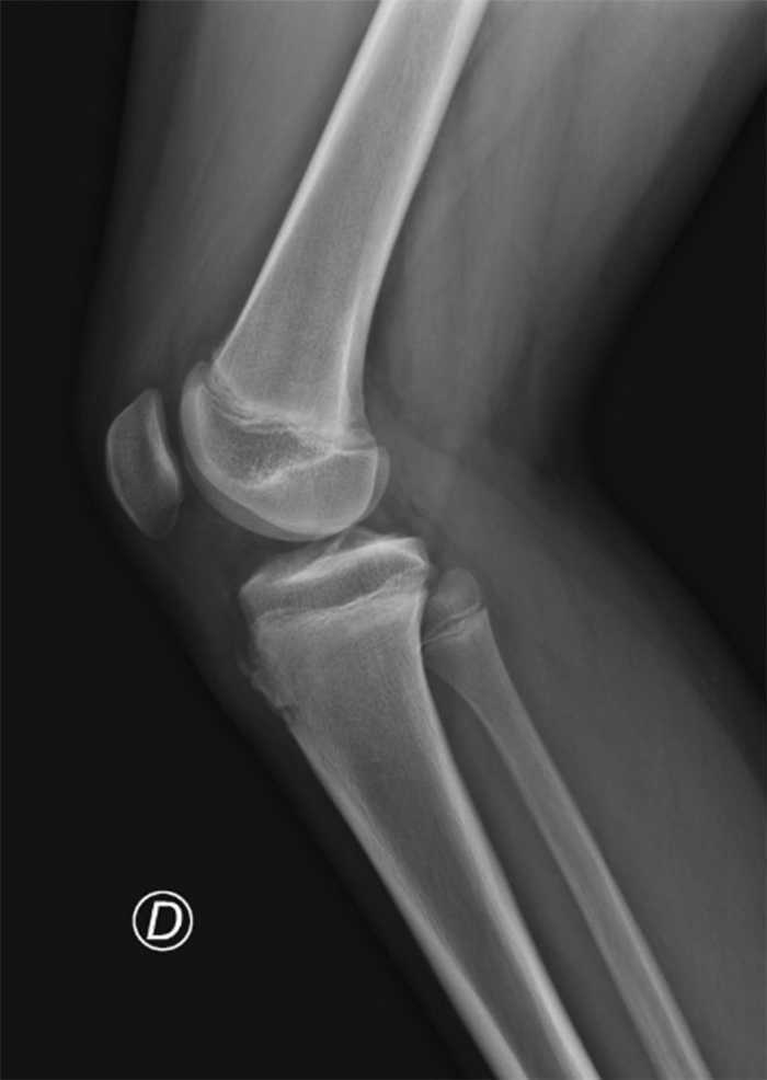 Lesiones y variantes normales de la rodilla pediátrica | Revista ...