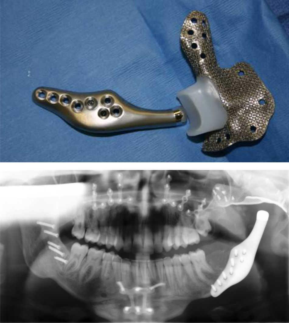 The role of custom-made prosthesis for temporomandibular joint ...