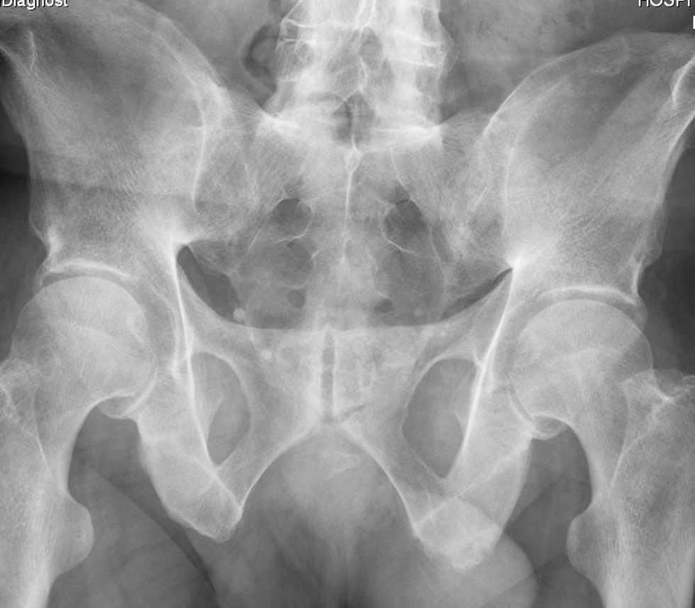 Radiografía de pelvis de paciente con espondilitis anquilosante ...