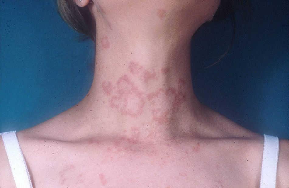 Tratamiento del lupus eritematoso cutáneo resistente | Seminarios de la ...