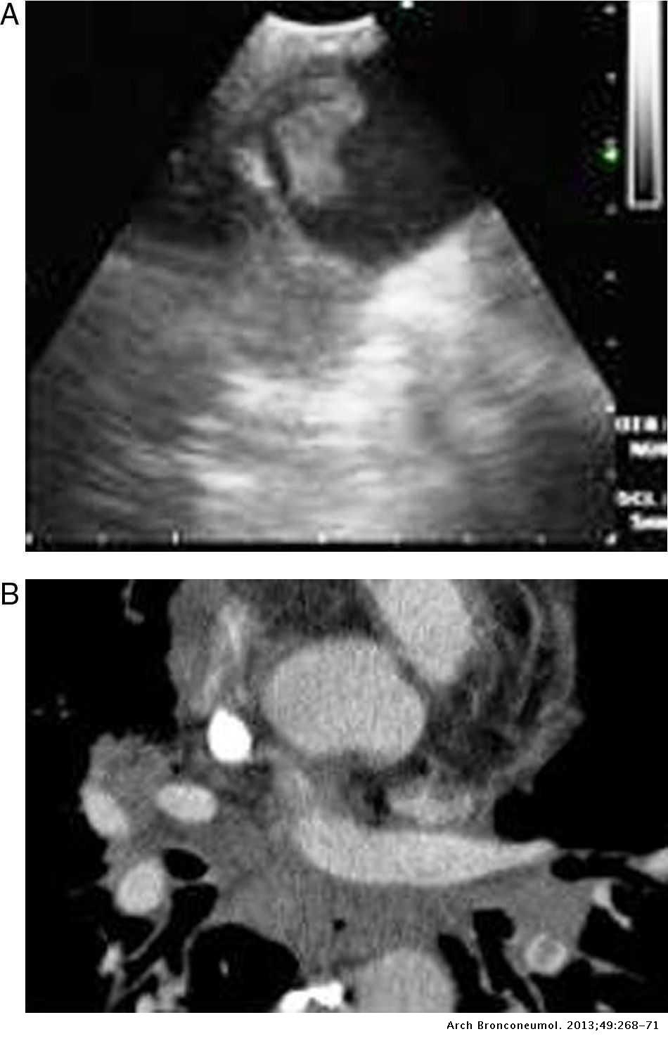 Diagnostic Imaging Of Pulmonary Embolism Using Endobronchial Ultrasound