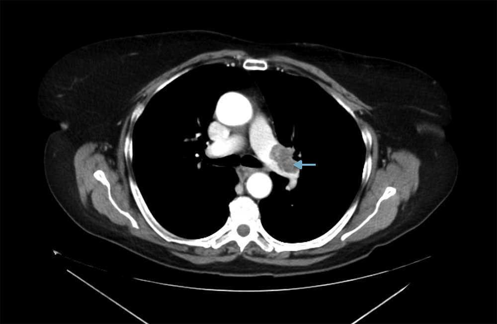 Intraluminal Lesion of the Pulmonary Artery: A Diagnostic Challenge ...