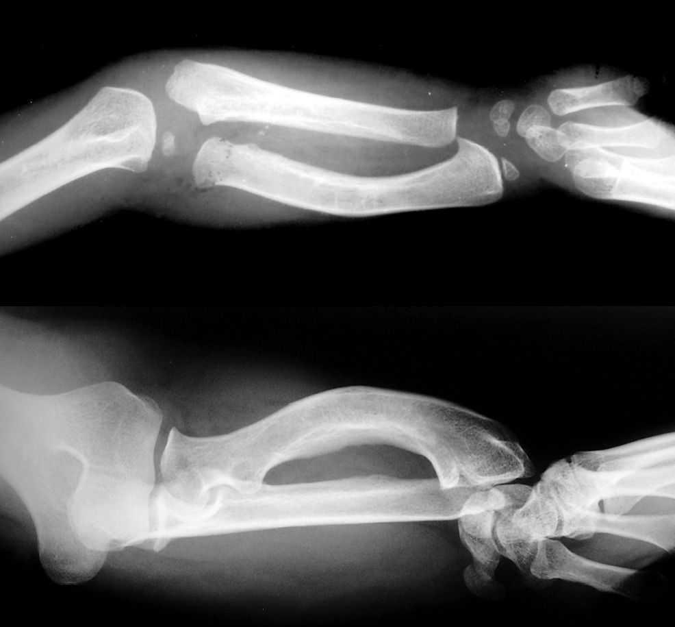 Discondrosteosis de Leri-Weill. Mutación en gen SHOX y expresividad ...