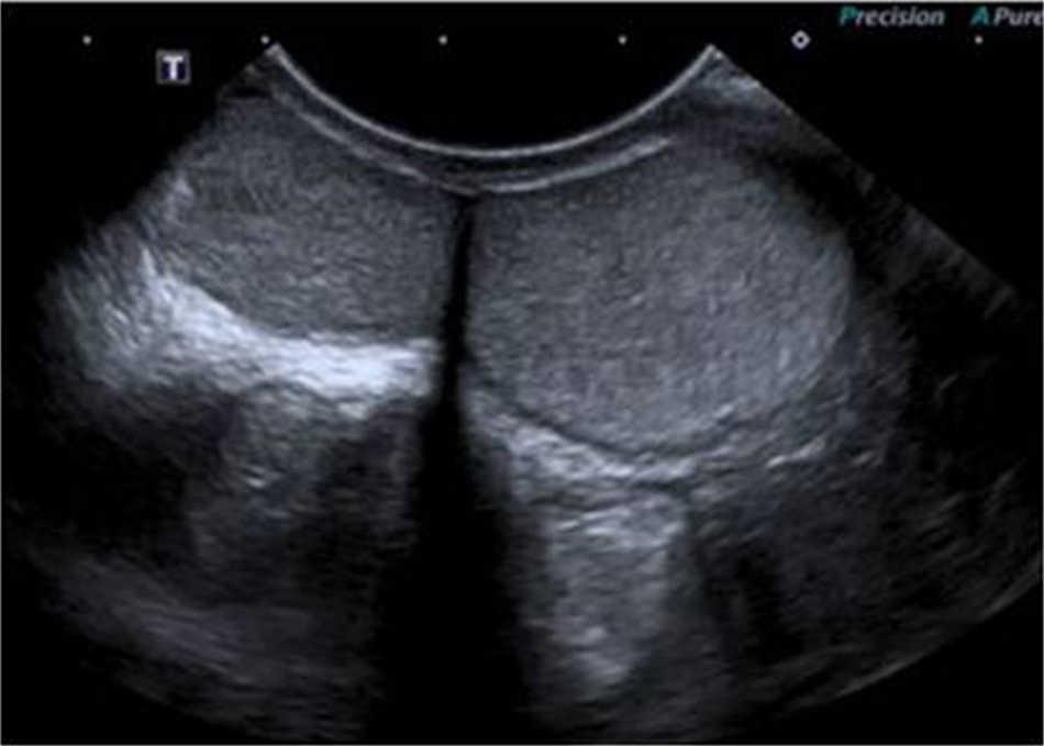 Triorquidismo como diagnóstico diferencial de las masas escrotales ...