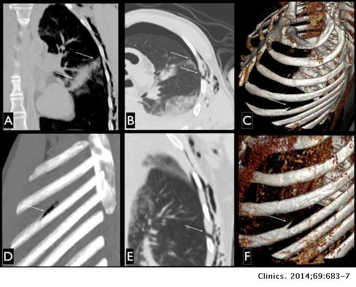 Differences Between Postmortem Computed Tomography And Conventional