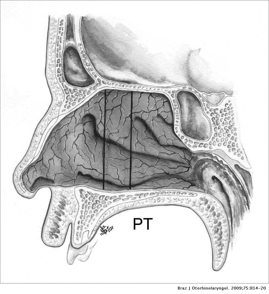 Reproducibility of the three-dimensional endoscopic staging system for ... Reproducibility of the three-dimensional endoscopic staging system for ...