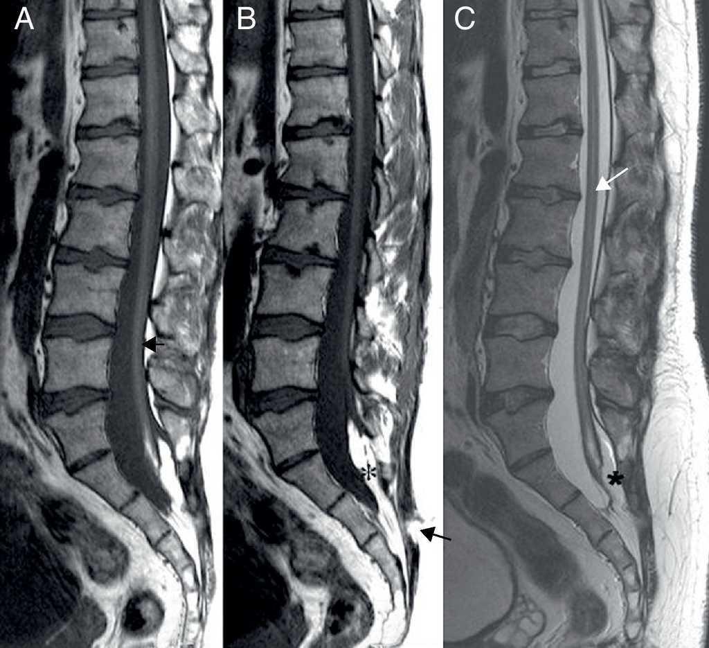 Síndrome de médula anclada de inicio en el adulto: 4 casos ...
