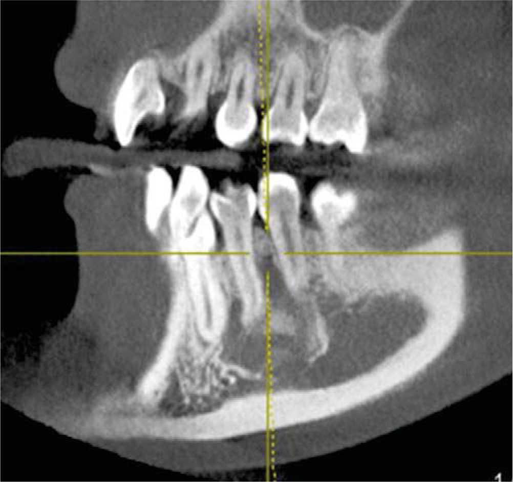 Solitary mandibular bone cyst. Case report and literature review ...
