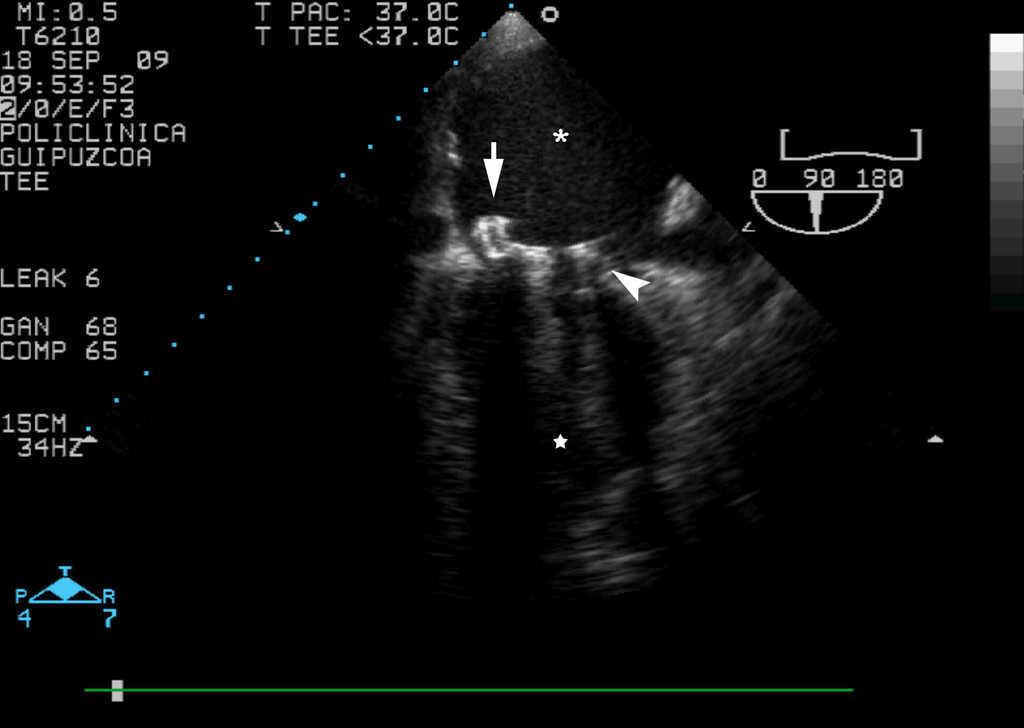 Transapical Technique as an Alternative Approach to Paravalvular Leak ...