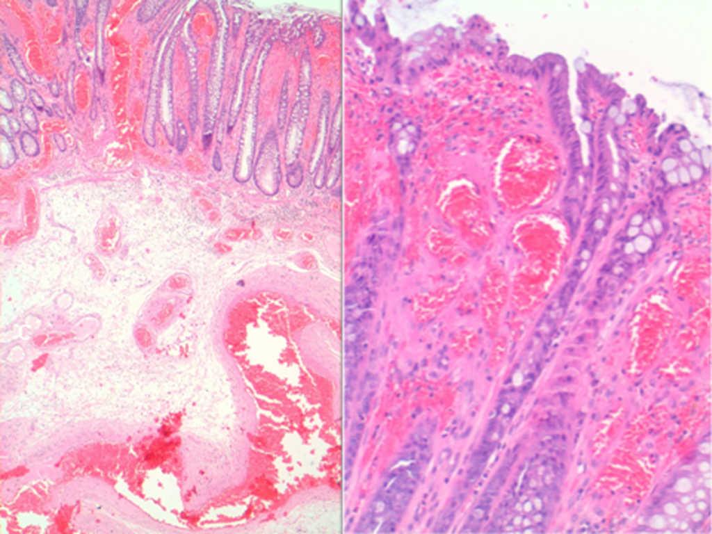 Heyde's Syndrome | Revista Española de Cardiología