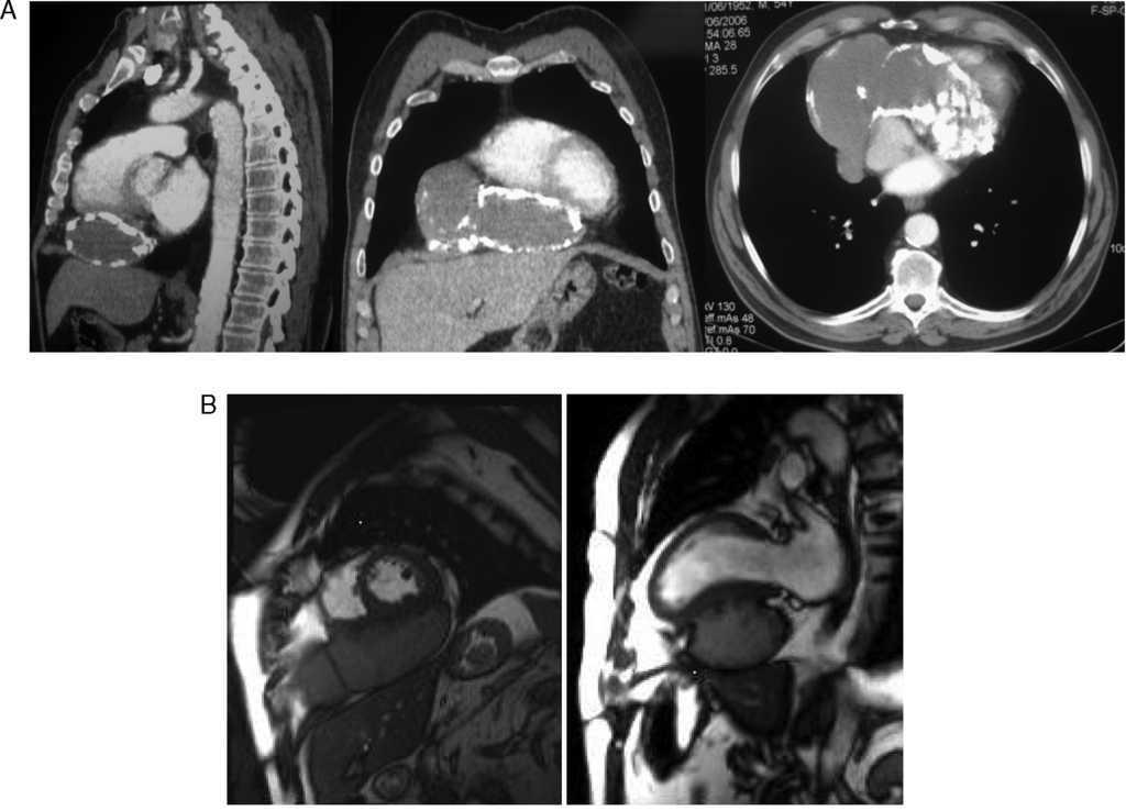 Isolated Pericardial Hydatid Cyst as a Casual Diagnosis | Revista ...