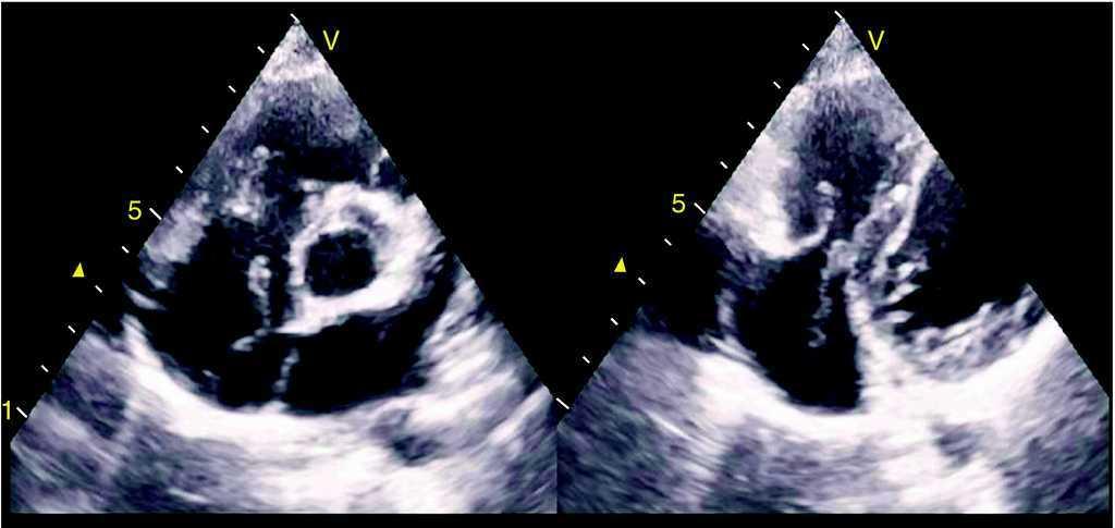 Chiari's Network and Paroxysmal Atrial Fibrillation | Revista Española ...