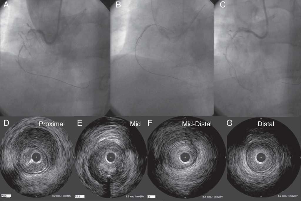Current Percutaneous Recanalization of Coronary Chronic Total Occlusion ...