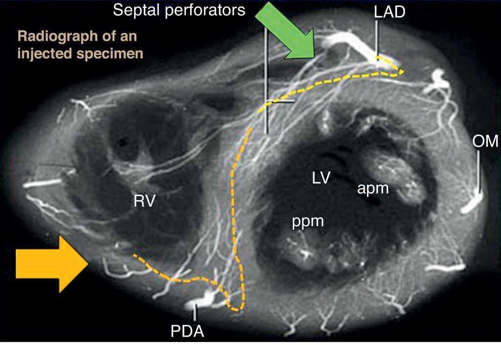 Current Percutaneous Recanalization of Coronary Chronic Total Occlusion ...