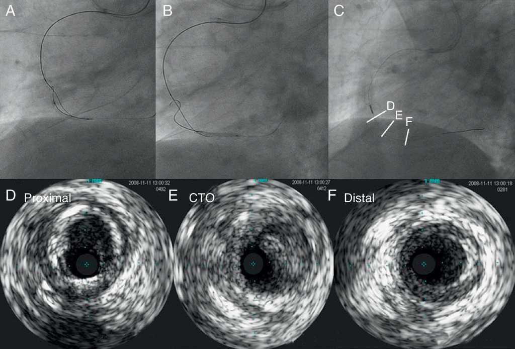 Current Percutaneous Recanalization of Coronary Chronic Total Occlusion | Revista Española de ...