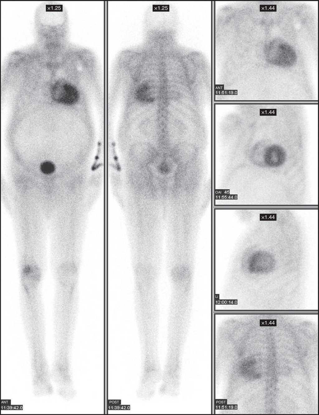 Role of Cardiac Scintigraphy With 99mTc-DPD in the Differentiation of ...