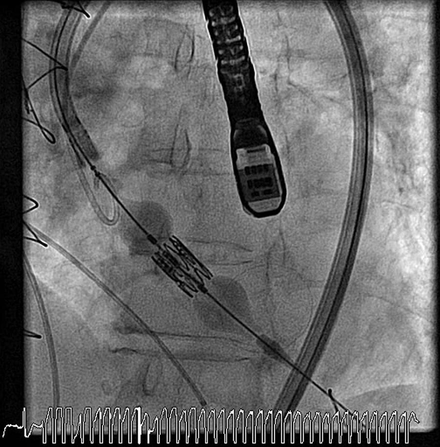 Transfemoral Aortic Valve Implantation in a Patient With Mitral ...