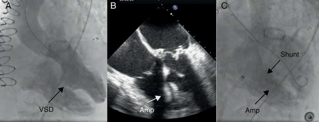 Structural Heart Intervention. Beyond Transcatheter Valve Therapy ...