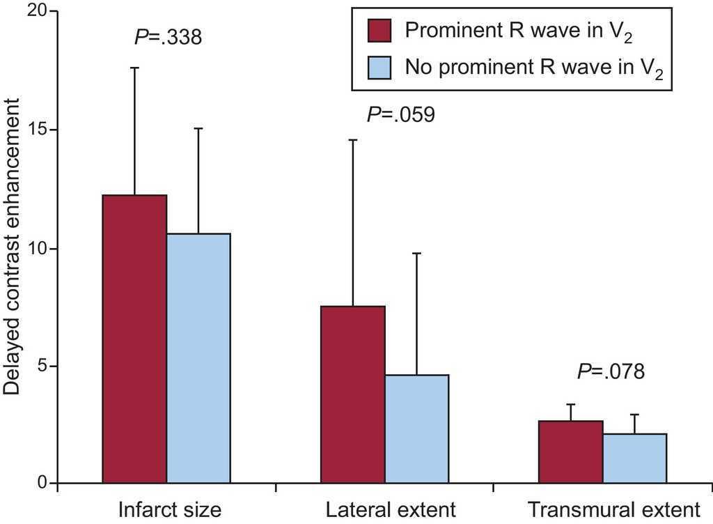 A Prominent R Wave in V 1 but not in V 2 Is a Specific Sign of a Large ...