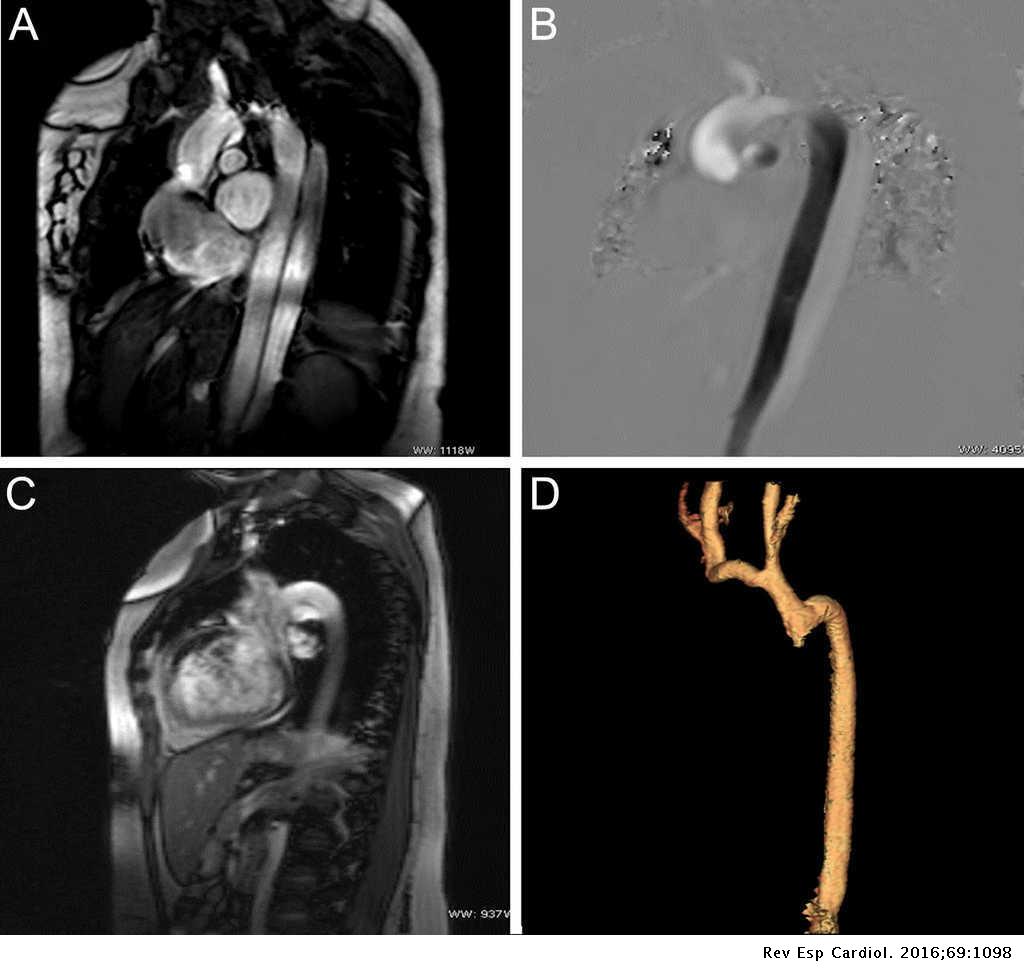 Isolated Anomaly of the Systemic Venous Return | Revista Española de ... Isolated Anomaly of the Systemic Venous Return | Revista Española de ...