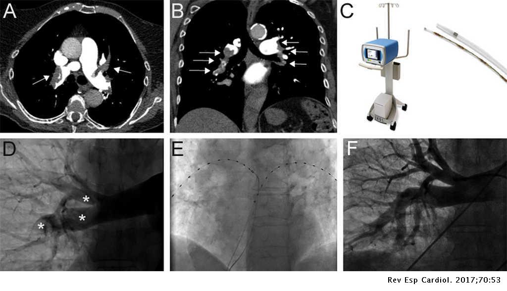 Ultrasound Accelerated Thrombolysis In A Sub Massive Pulmonary Embolism