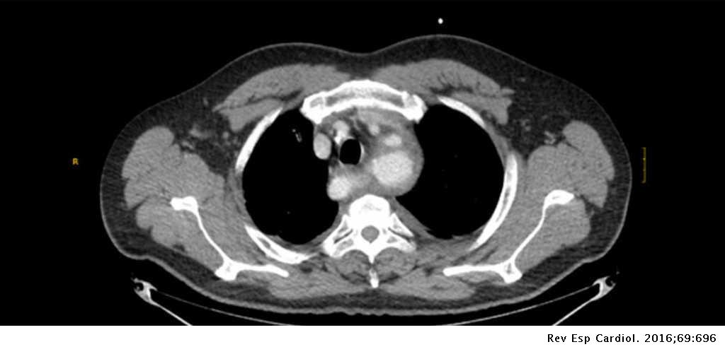 Kommerell Diverticulum and Aberrant Right Subclavian Artery | Revista ... Kommerell Diverticulum and Aberrant Right Subclavian Artery | Revista ...