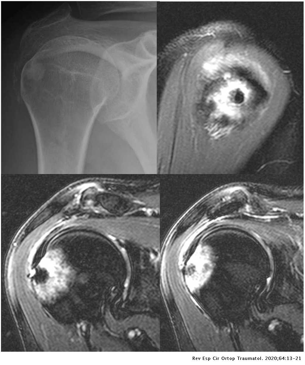 Calcific Tendinopathy Of The Shoulder With Intraosseous Extension