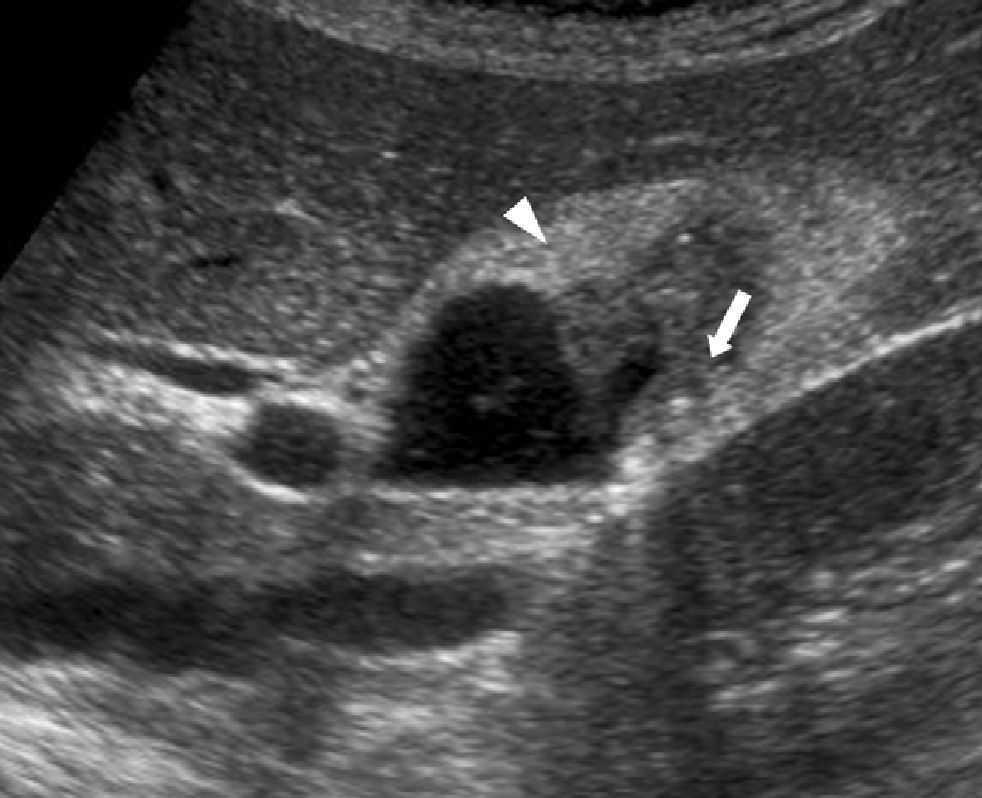 Surgical Indications in Gallbladder Polyps | Cirugía Española (English ...