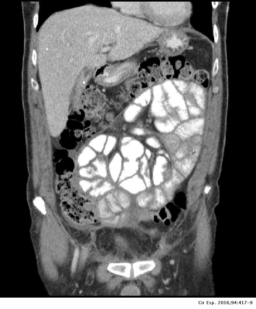 Abdominal Cocoon A Rare Cause Of Intestinal Obstruction Cirugía